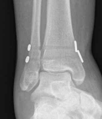 Fibula fractures | The Bone School